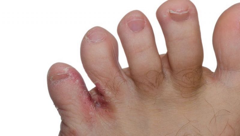 How Can I Prevent Athletes Foot Foot Healthcare Associates